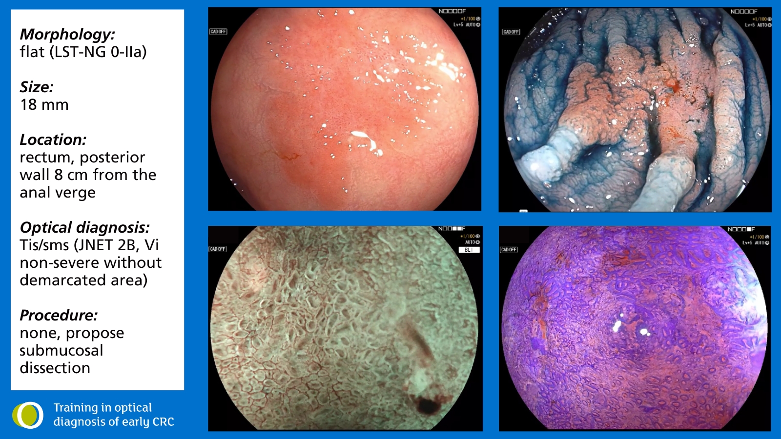 Optical Diagnosis for Colorectal Polyp Care Training - The Training in ...